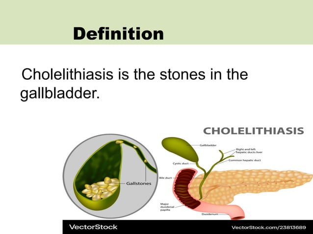 CHOLELITHIASIS (gall bladder stone).pptx