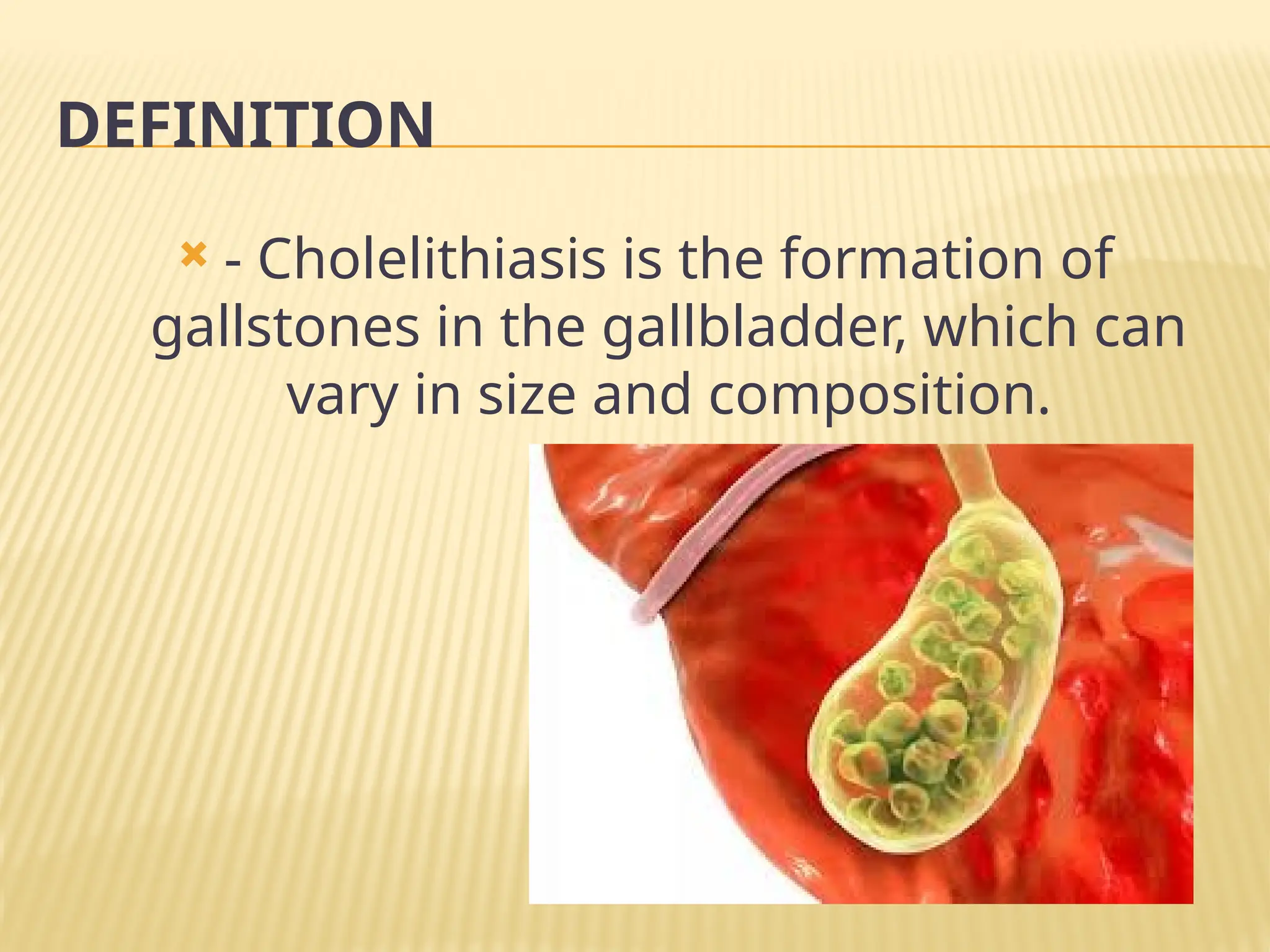 cholelithiasis. Clinical features. Treatment | PPTX