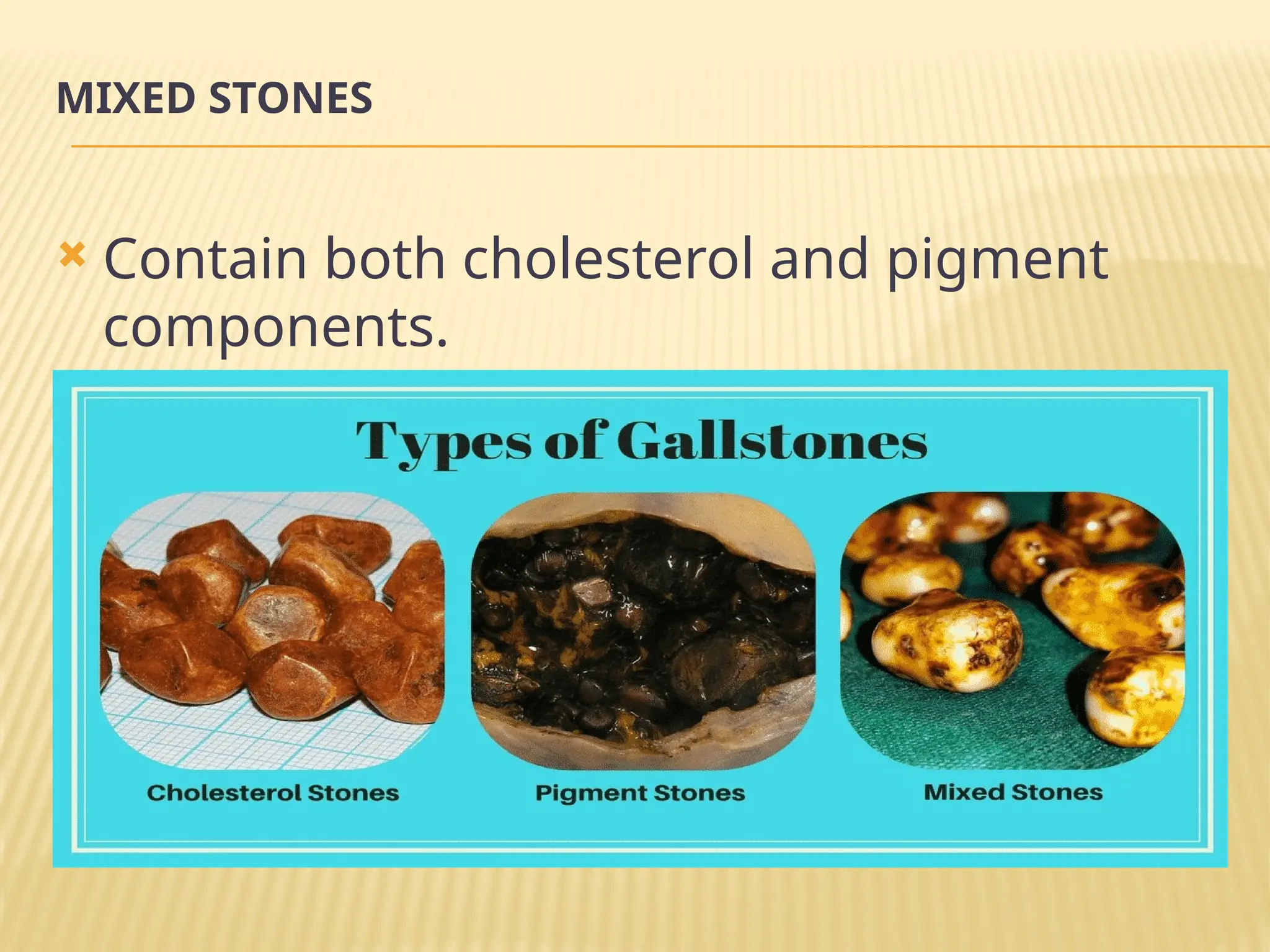 cholelithiasis. Clinical features. Treatment | PPTX