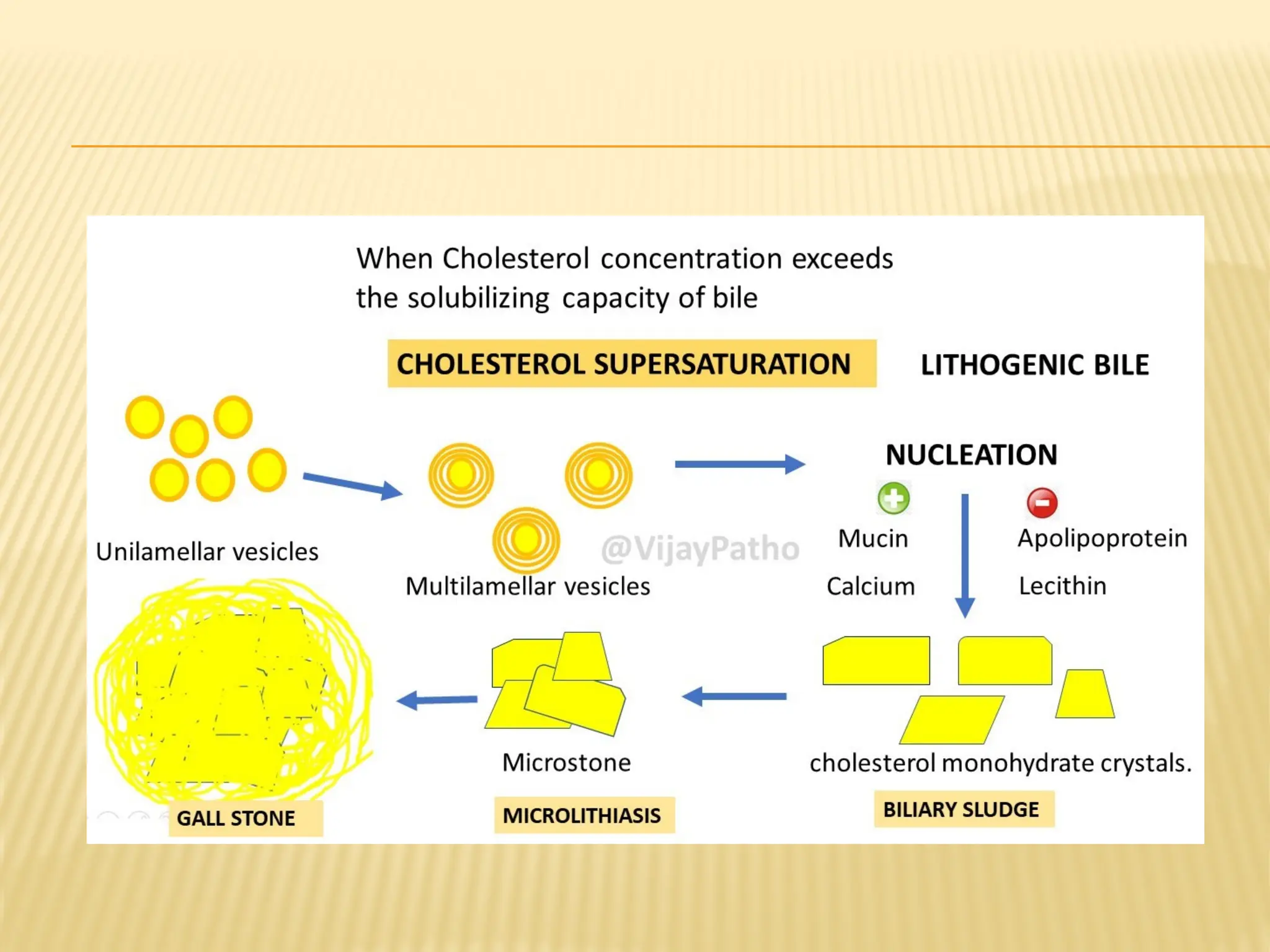 cholelithiasis. Clinical features. Treatment | PPTX