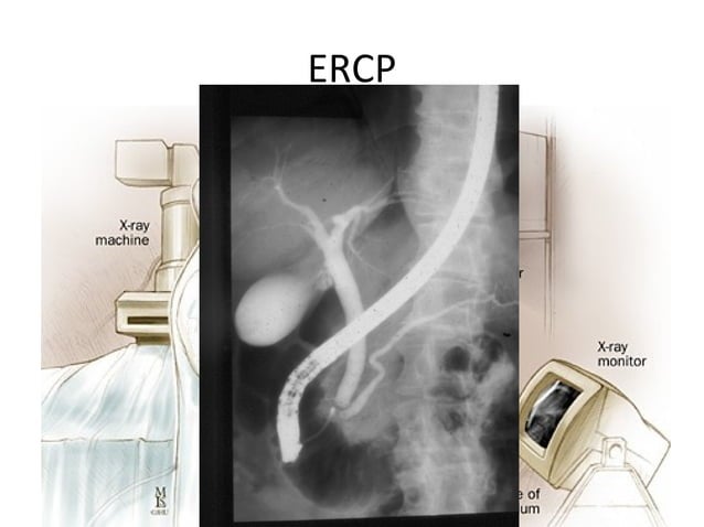 Cholelithiasis final year lecture