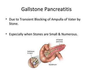 Cholelithiasis final year mbbs lecture | PPT