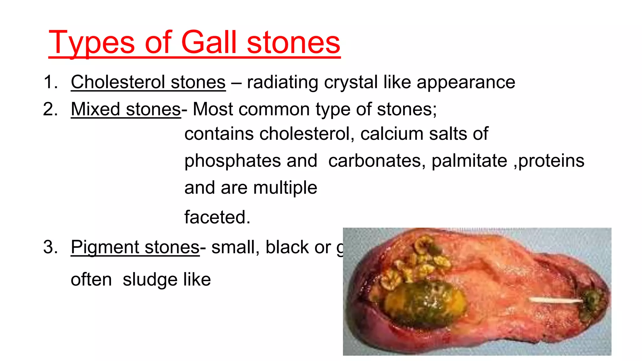cholelithiasis-lecture.pptx