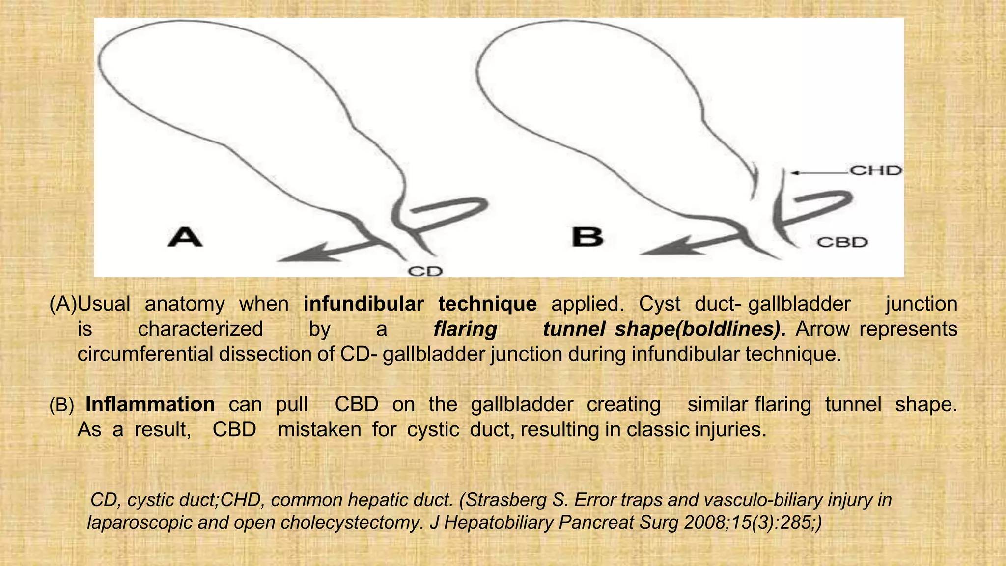 cholelithiasis-lecture.pptx