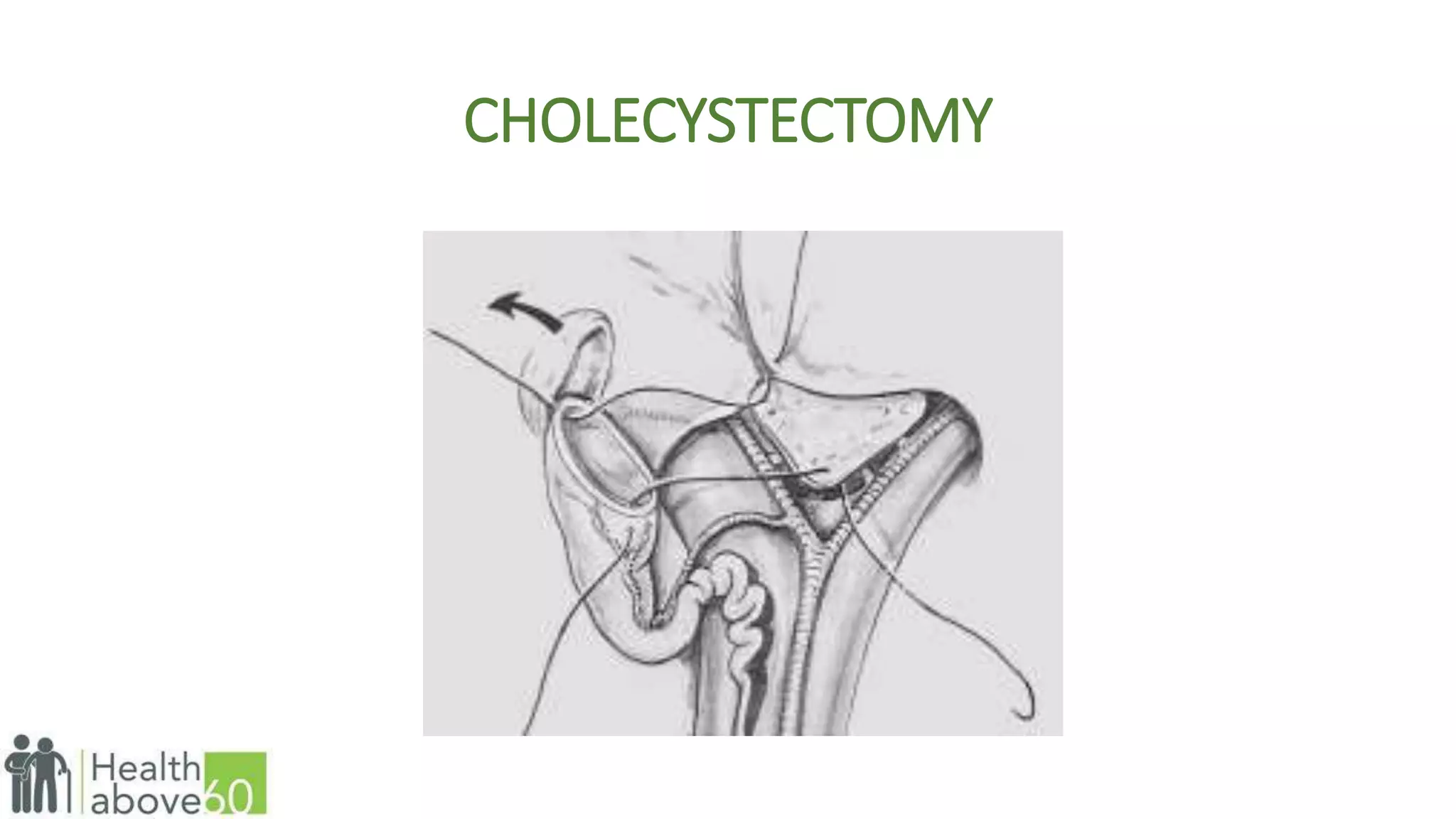 Anatomy of Cholelithiasis | PPTX