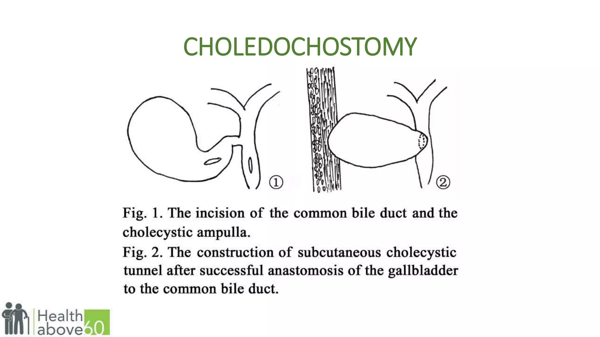 Anatomy of Cholelithiasis | PPTX