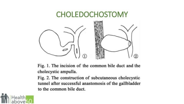 Anatomy of Cholelithiasis