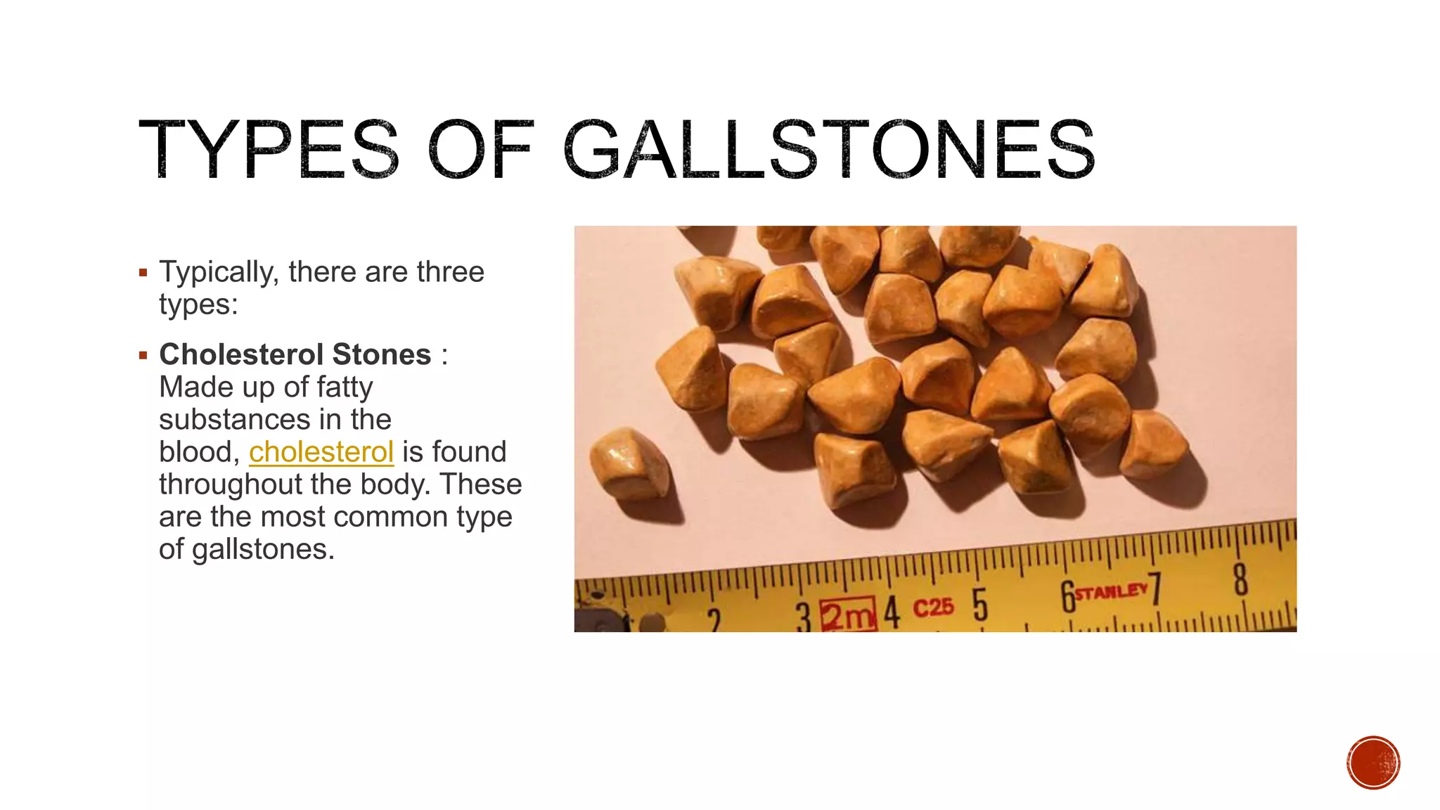Cholelithiasis ( gallstones) | PPTX