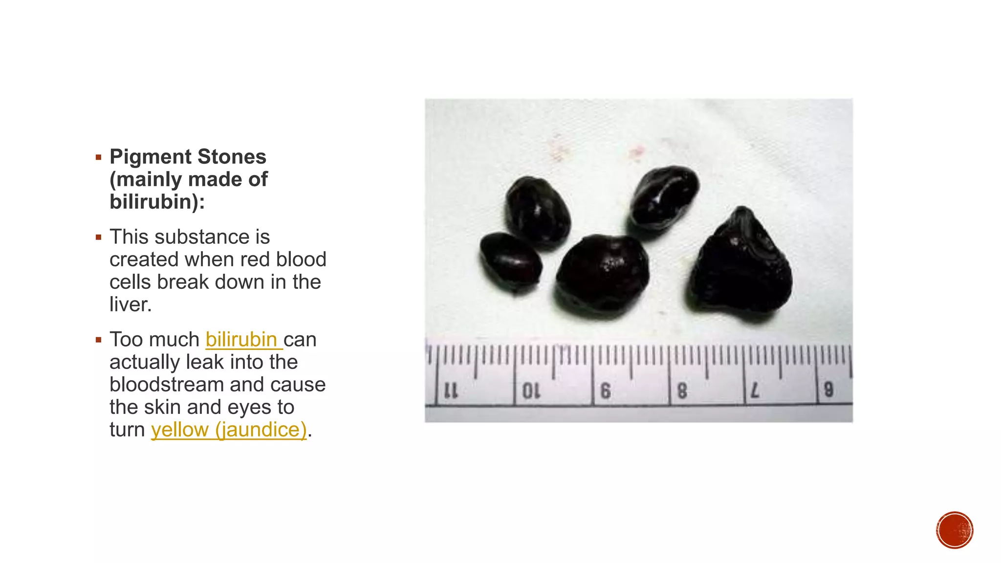 Cholelithiasis ( gallstones) | PPTX