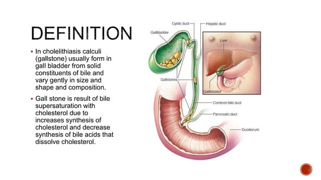 Cholelithiasis ( gallstones) | PPTX