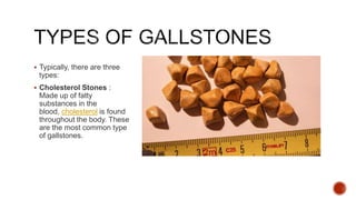 Cholelithiasis ( gallstones) | PPTX