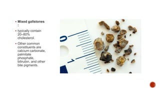 Cholelithiasis ( gallstones) | PPTX