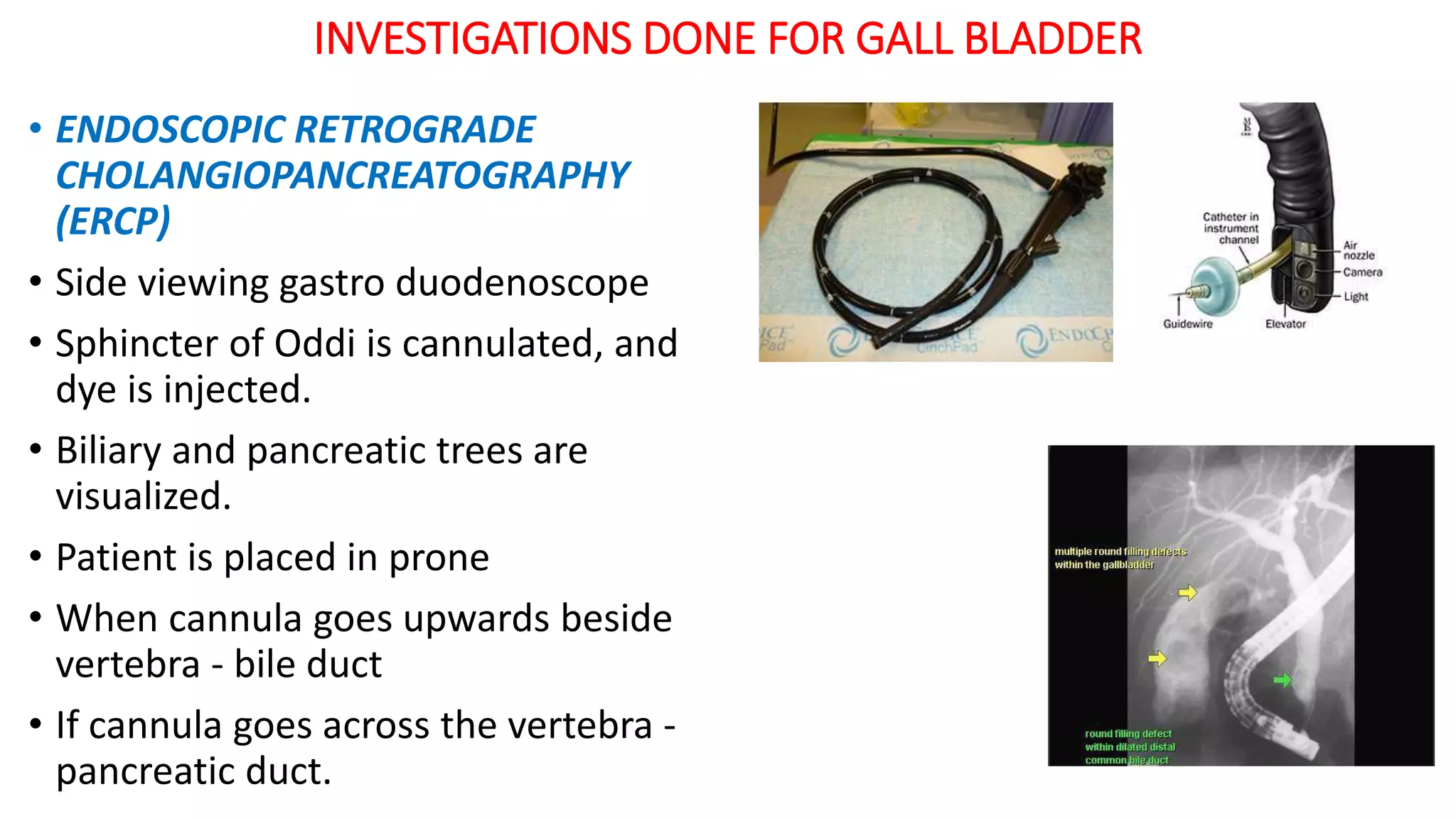 Cholelithiasis and cholecystitis | PPTX
