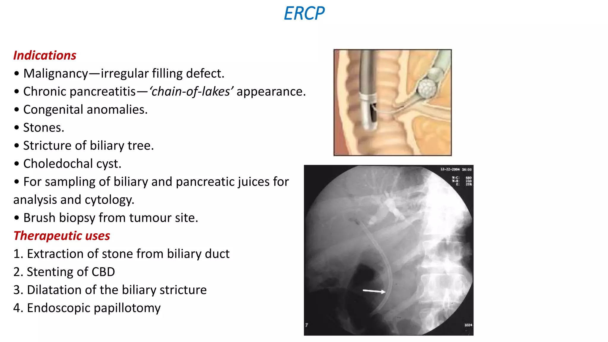 Cholelithiasis and cholecystitis | PPTX
