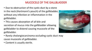 Cholelithiasis and cholecystitis | PPTX