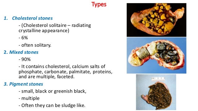 Cholelithiasis and cholecystitis