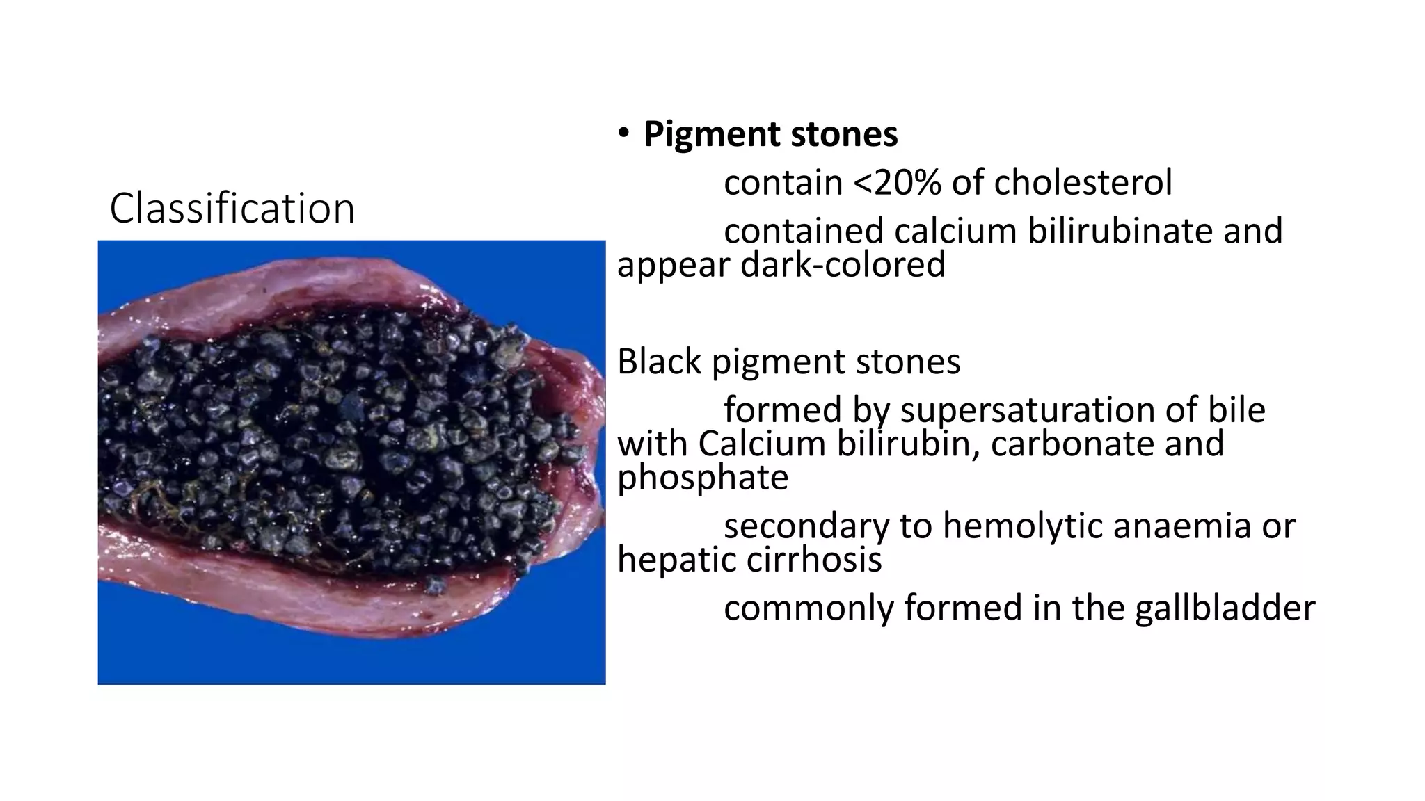 Cholelithiasis and Cholecystitis.pptx