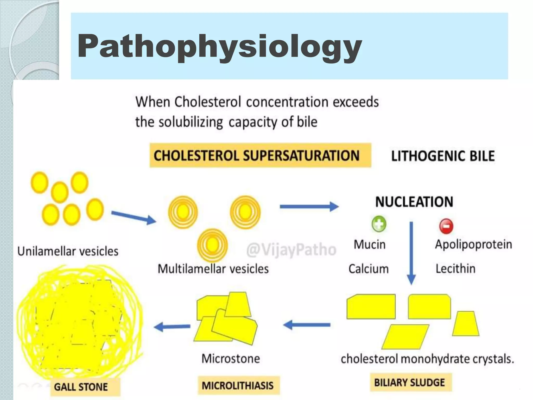 Cholelithiasis and cholecystitis, sunita kharel | PPT