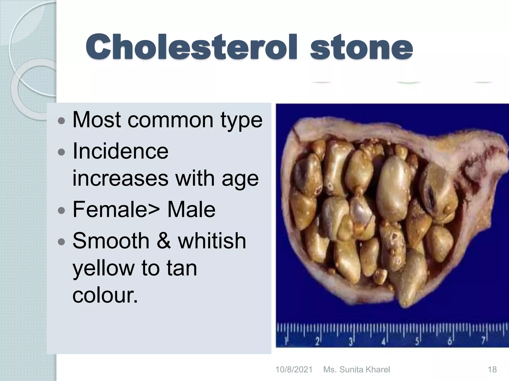 Cholelithiasis and cholecystitis, sunita kharel | PPT