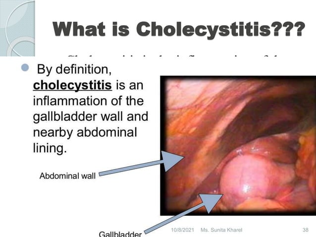 Cholelithiasis and cholecystitis, sunita kharel | PPT