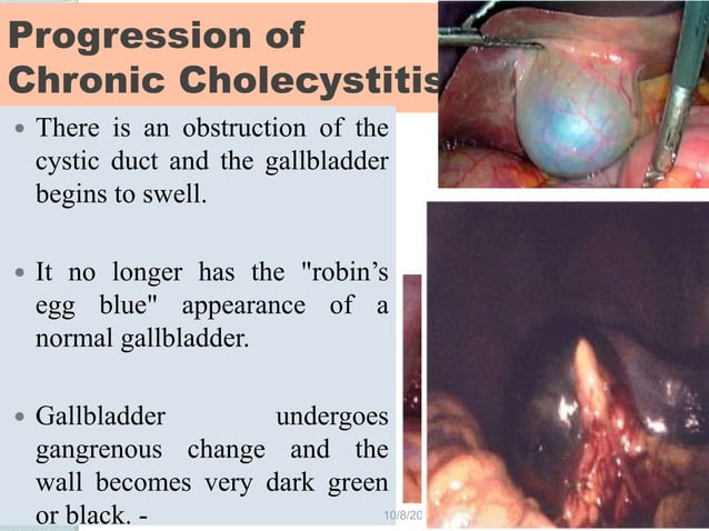 Cholelithiasis and cholecystitis, sunita kharel | PPT