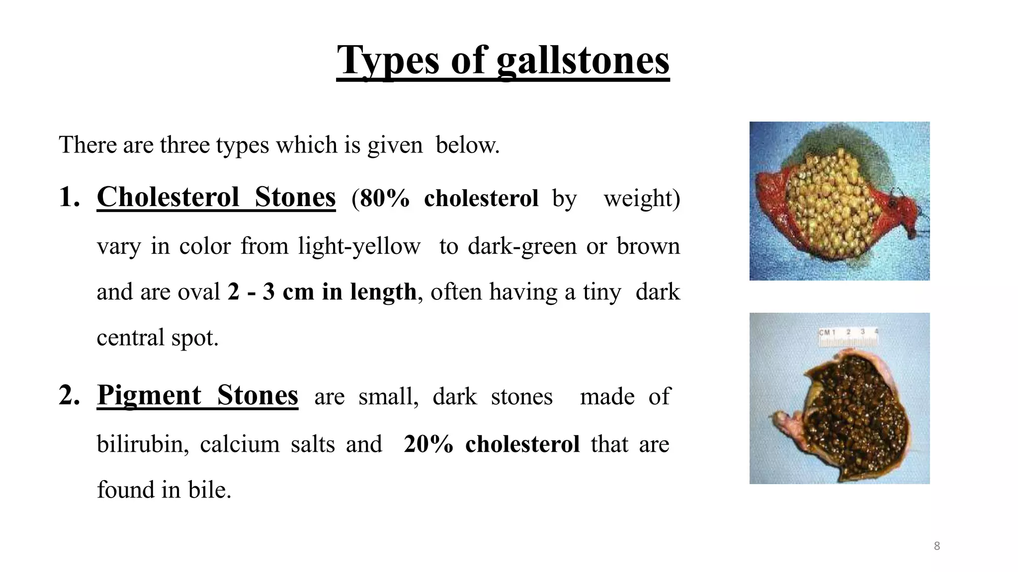 cholelithiasis, by Baqir Naqvi.pptx