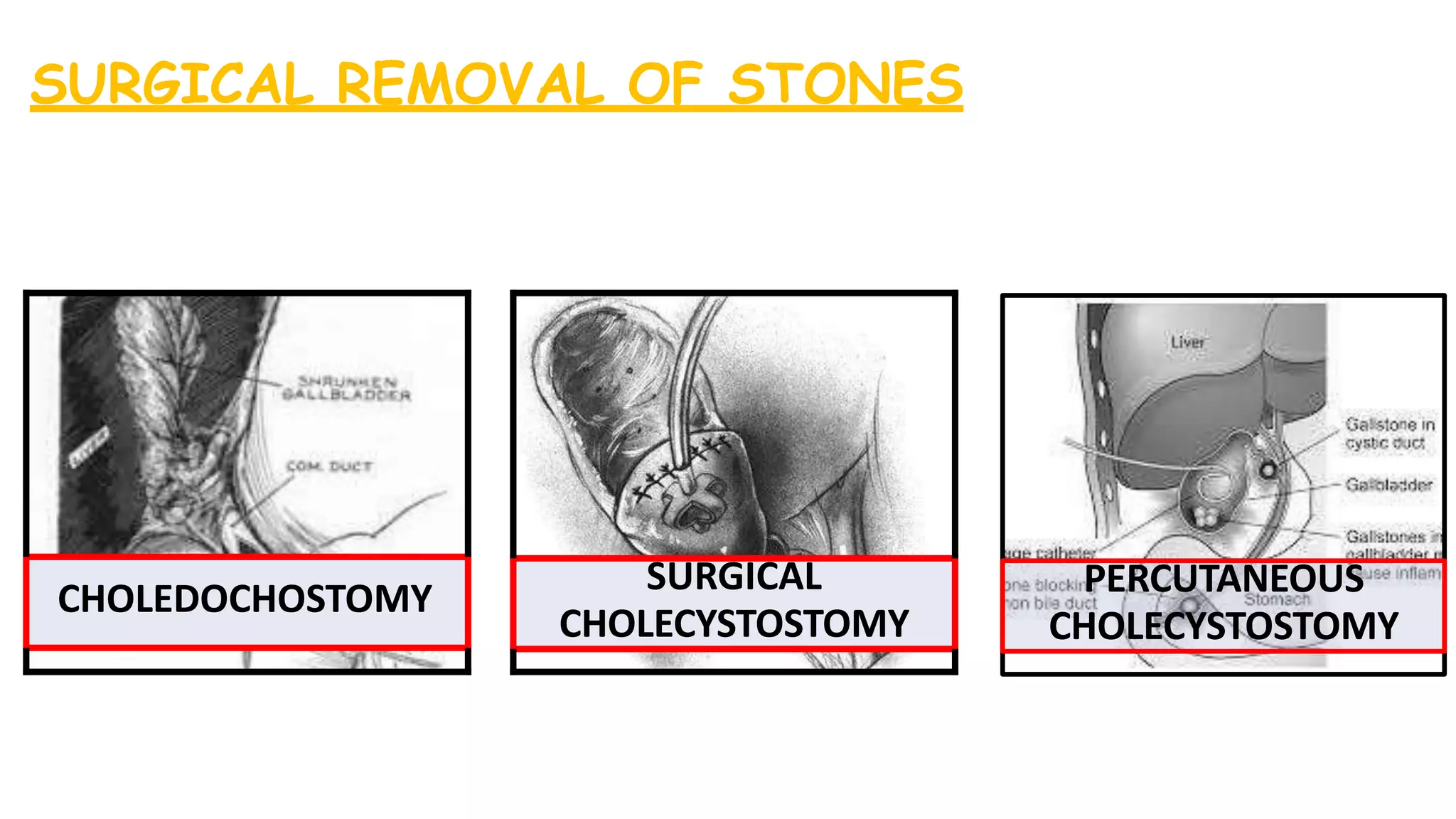 cholelithiasis & choledolithiasis.pptx