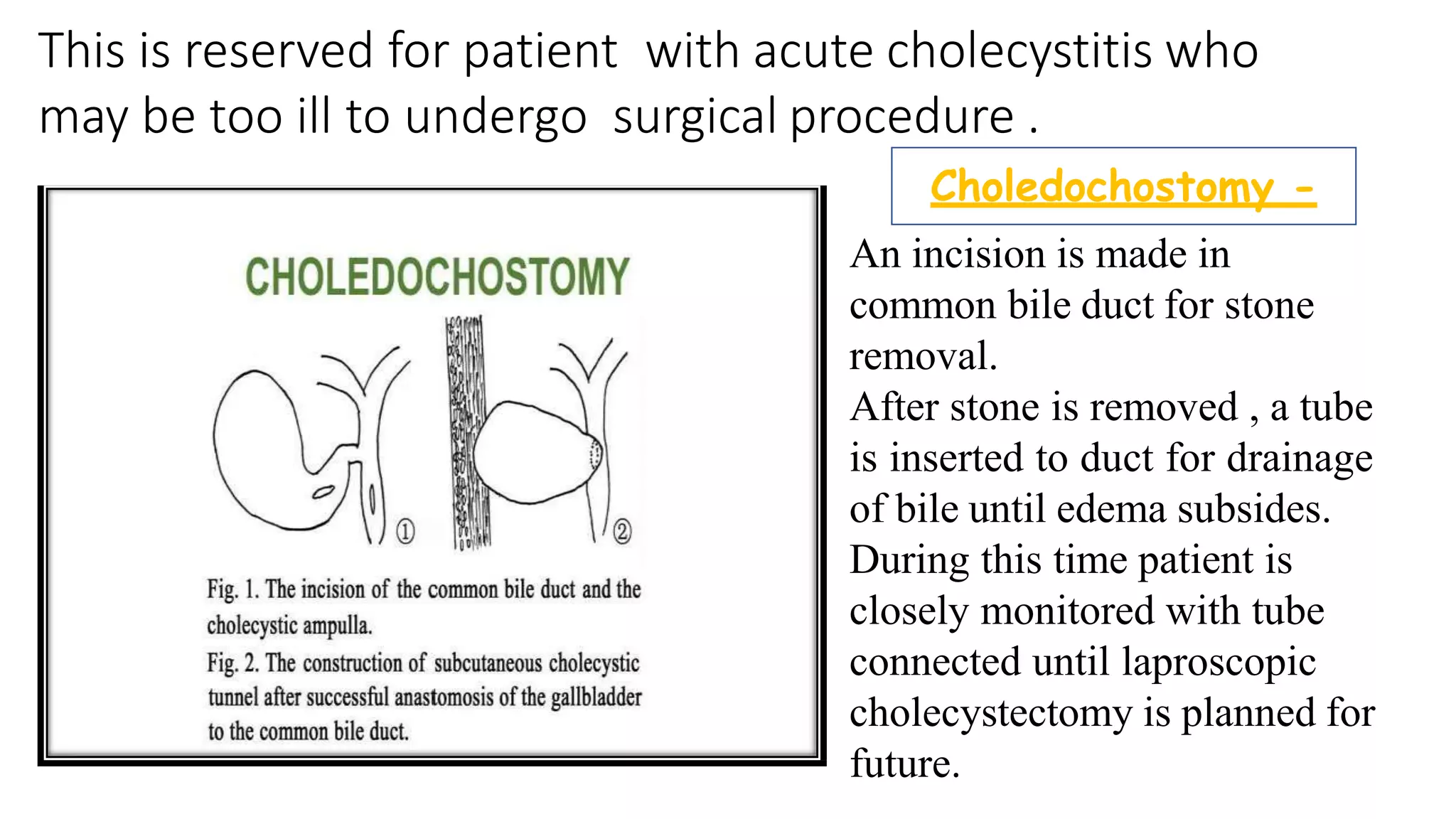 cholelithiasis & choledolithiasis.pptx
