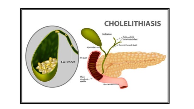 cholelithiasis & choledolithiasis.pptx