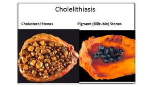 cholelithiasis & choledolithiasis.pptx