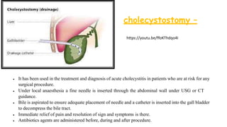cholelithiasis & choledolithiasis.pptx