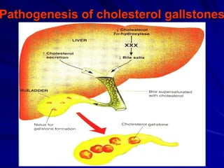 Cholelitiasis and its complications. (lecture vasilevsky v.p.) | PDF