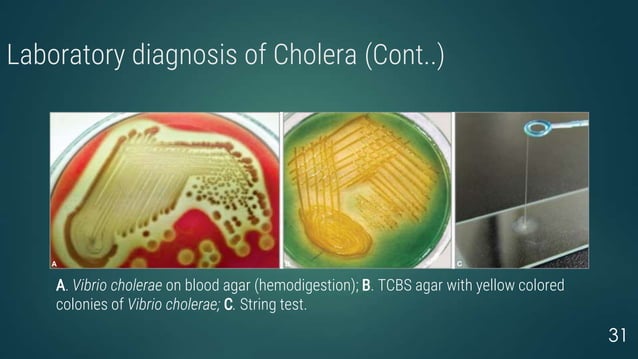 CHOLERA AND ITS CLINICAL FEATURE &LAB DIAGNOSIS .pptx