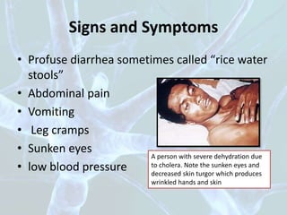 Cholera disease | PPTX