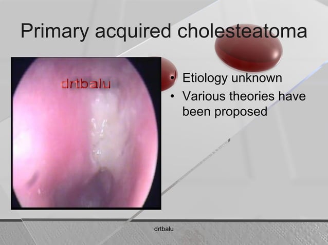 Cholesteatoma | PDF