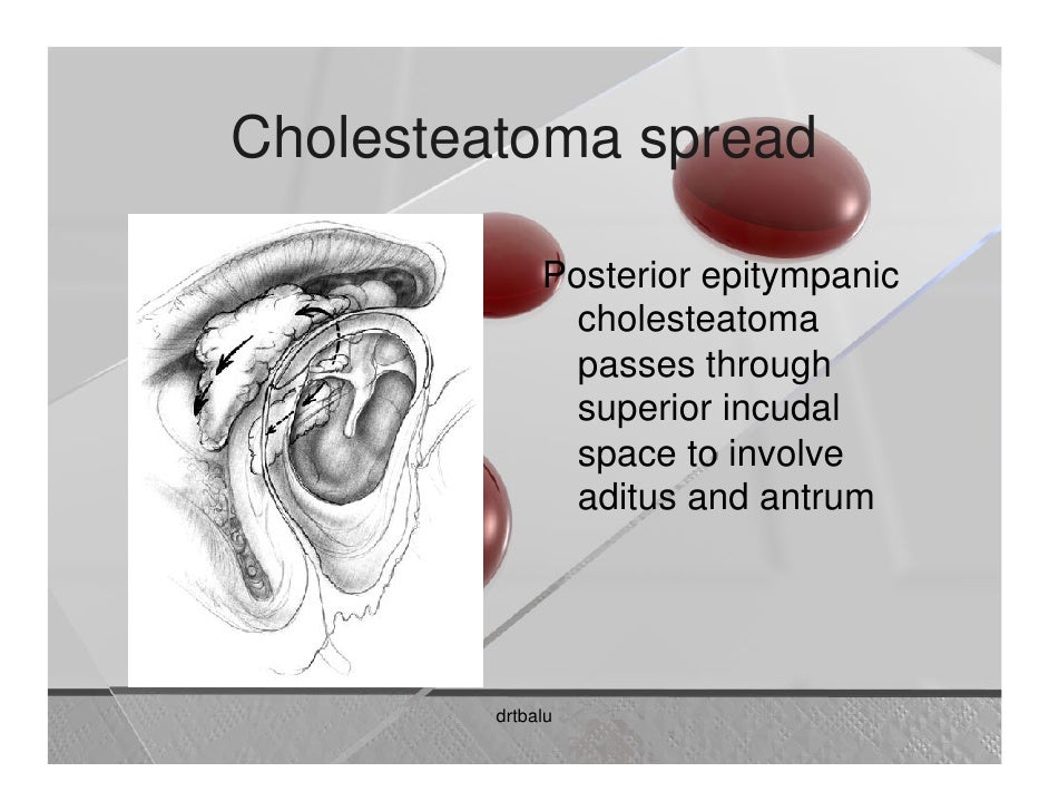 Cholesteatoma