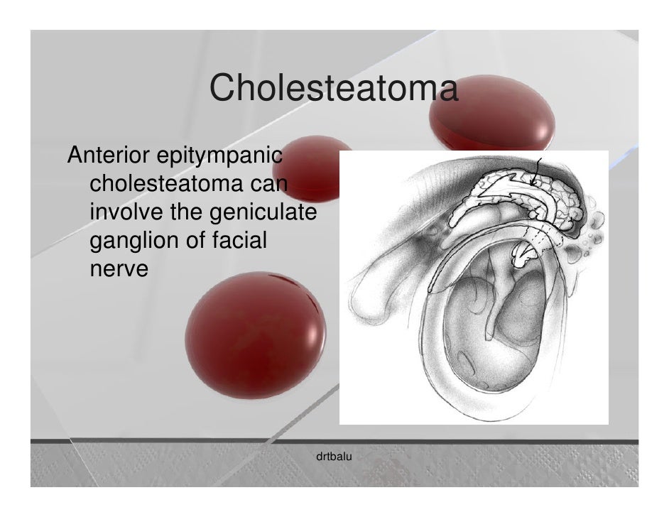Cholesteatoma