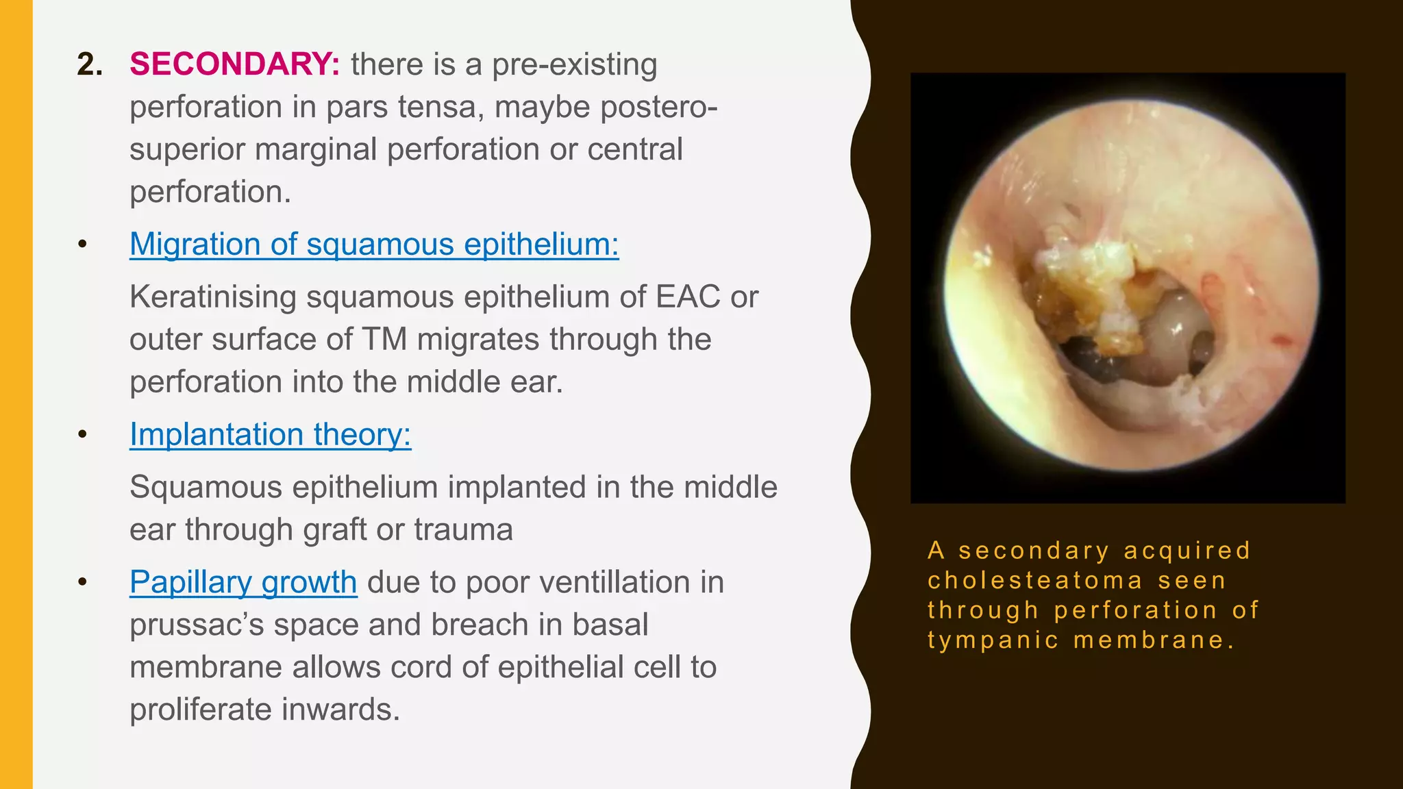 Cholesteatoma | PPTX