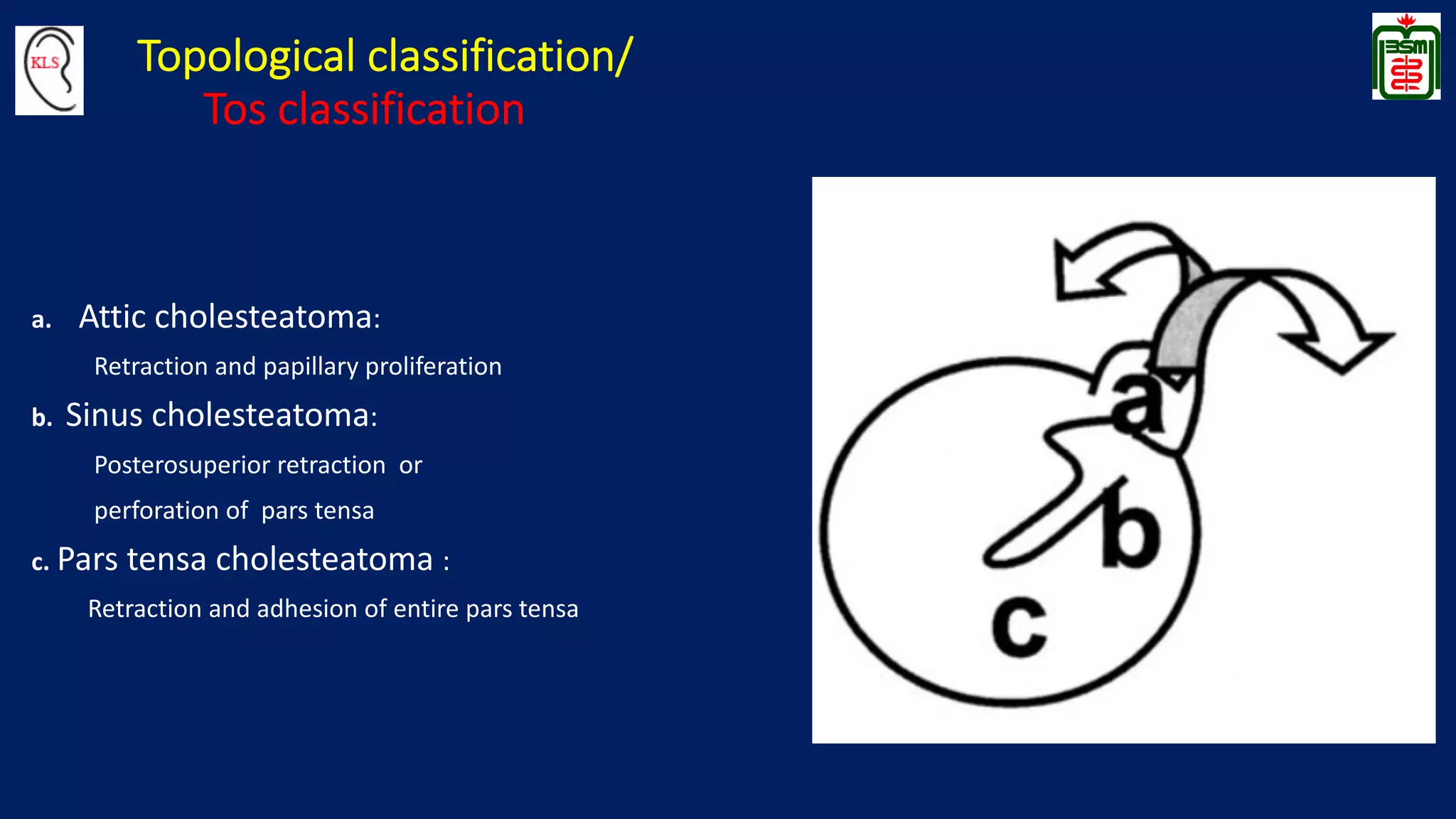 Cholesteatoma | PDF