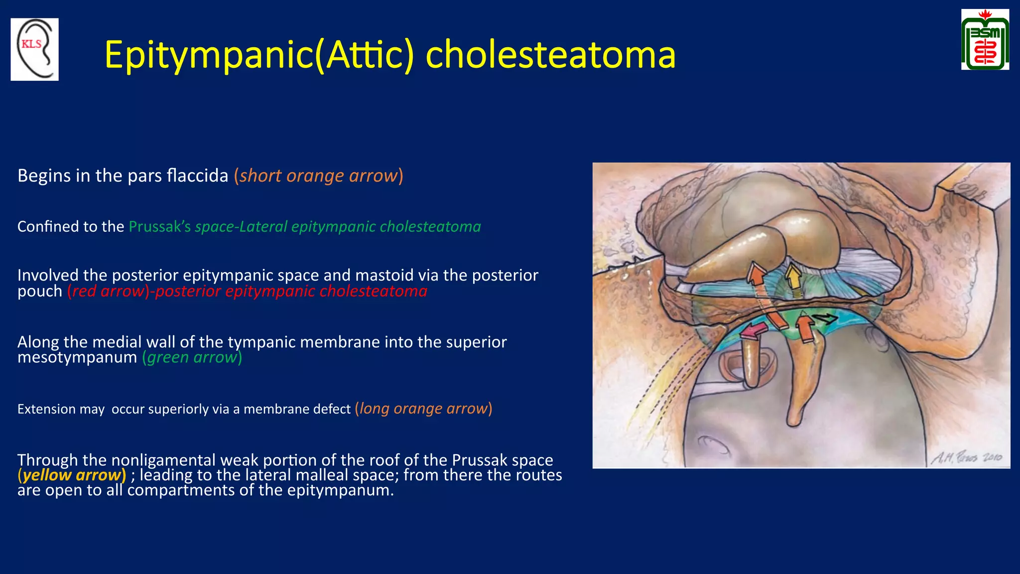 Cholesteatoma | PDF