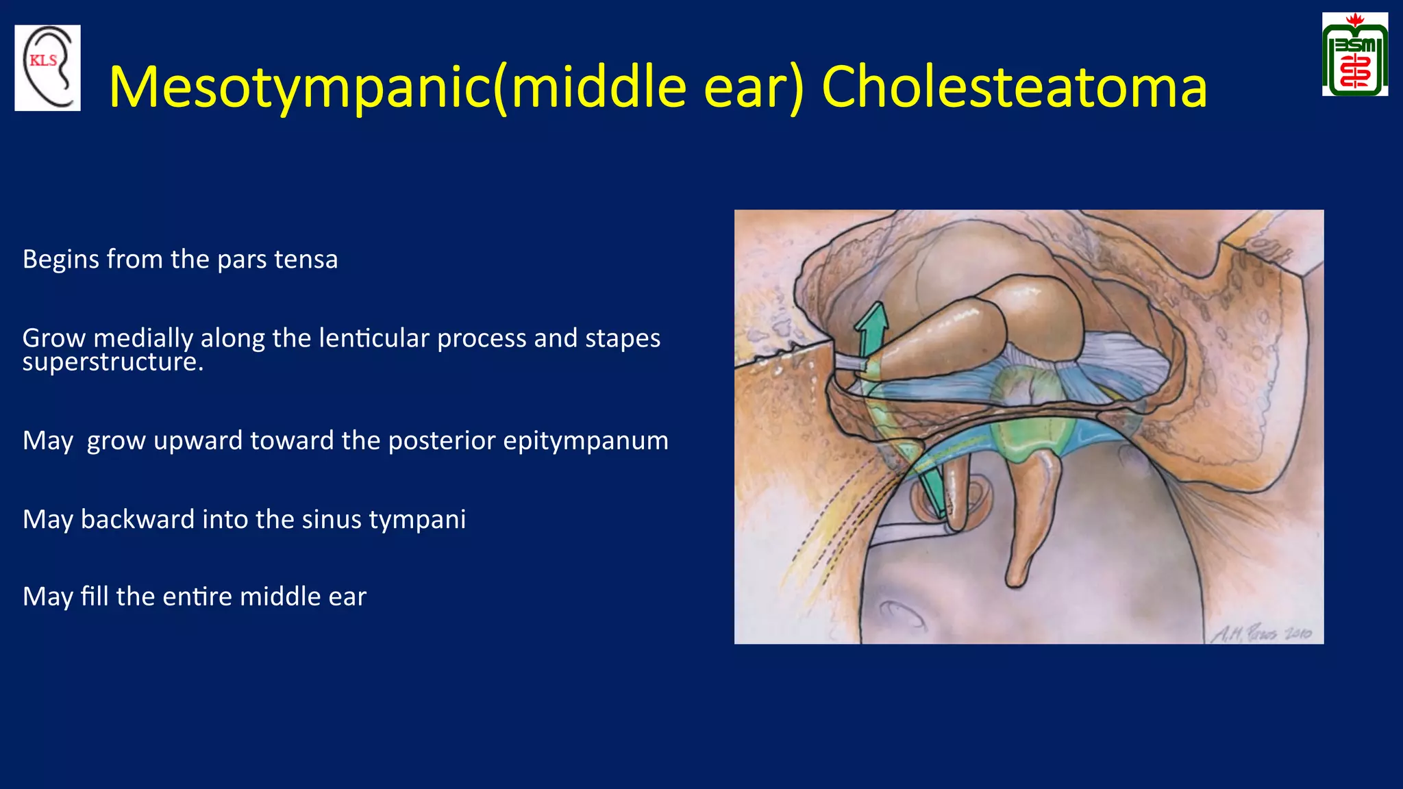 Cholesteatoma | PDF