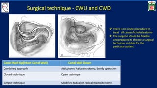 Cholesteatoma | PDF