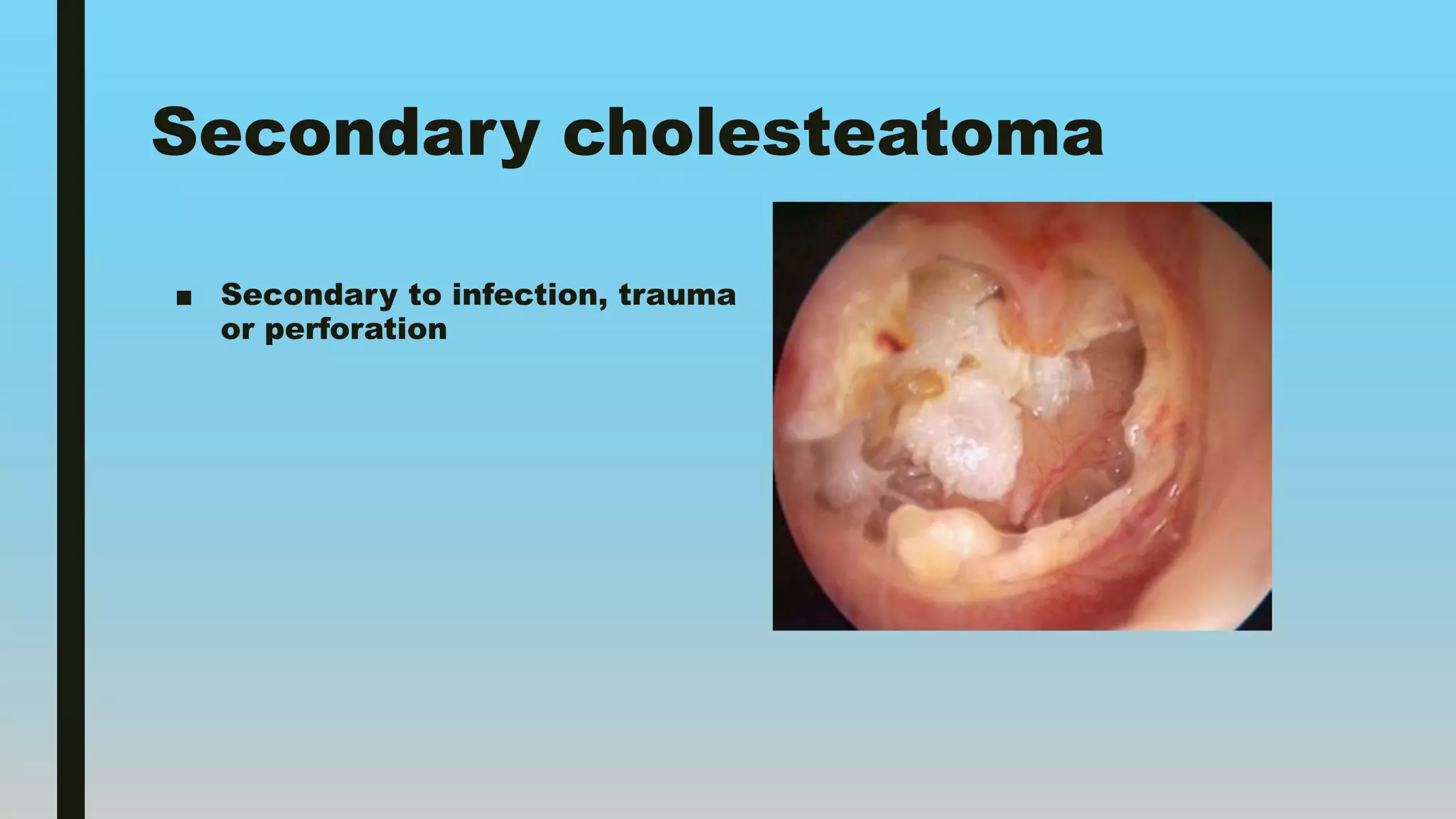 Cholesteatoma | PPTX