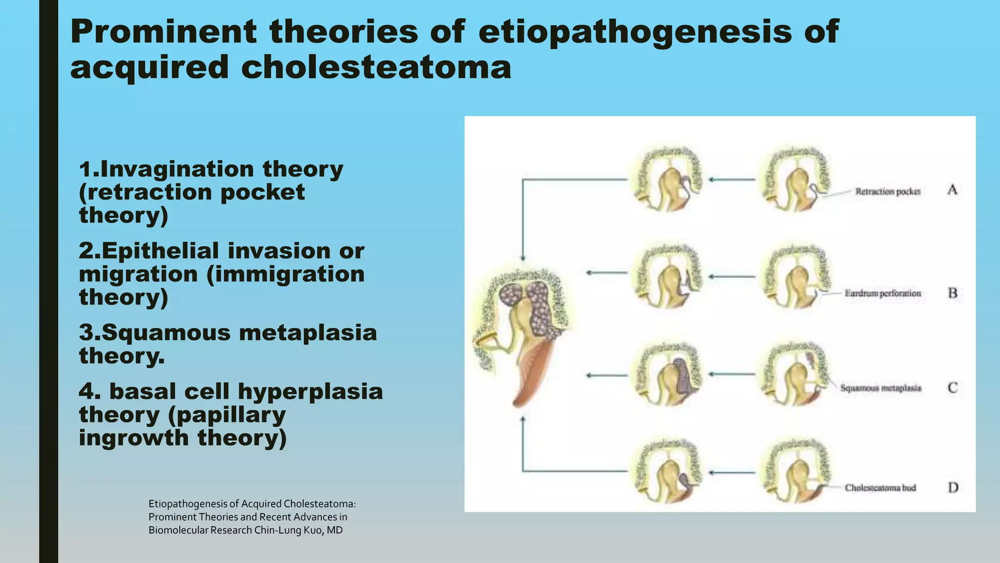 Cholesteatoma | PPTX