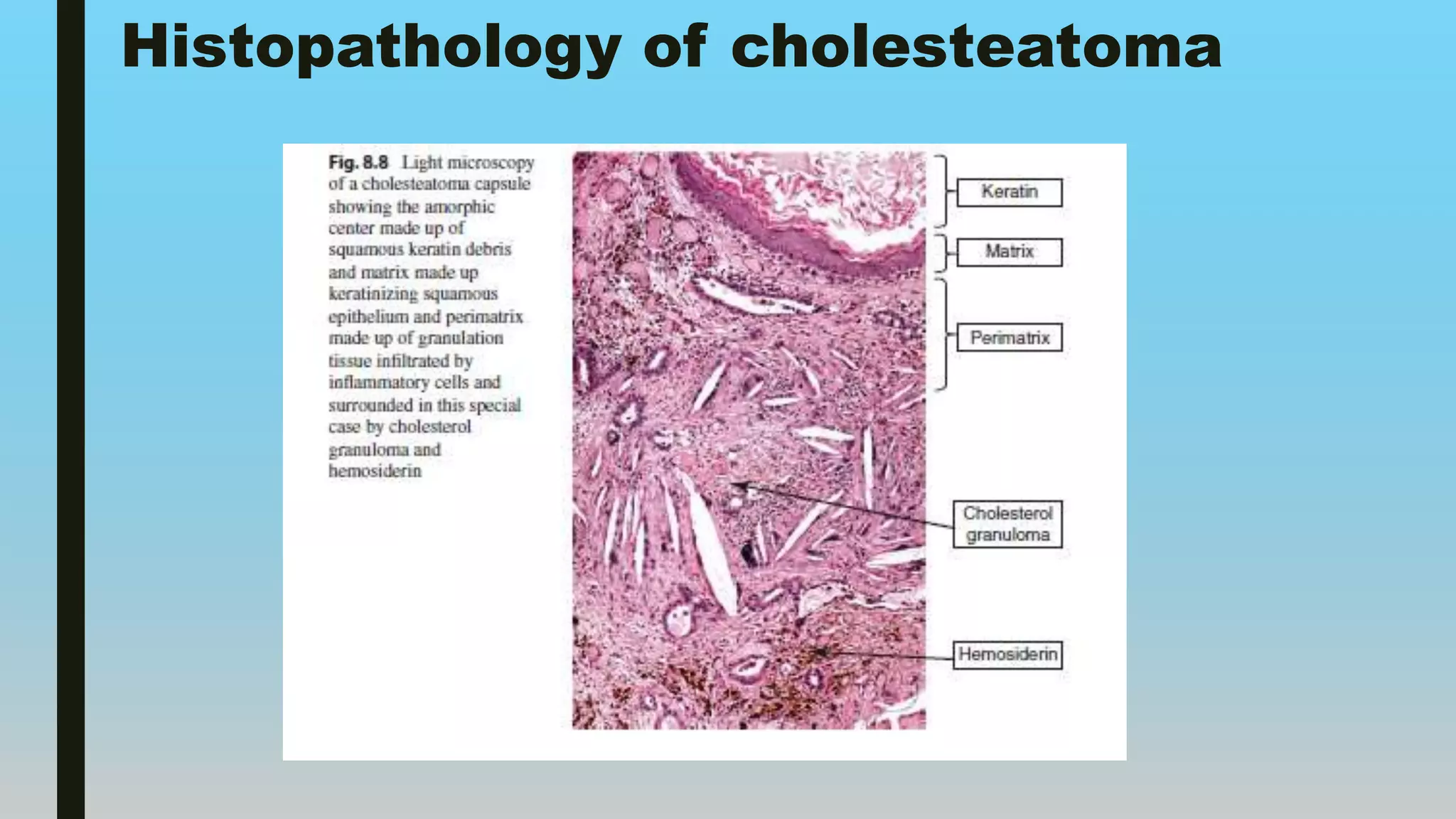 Cholesteatoma | PPTX