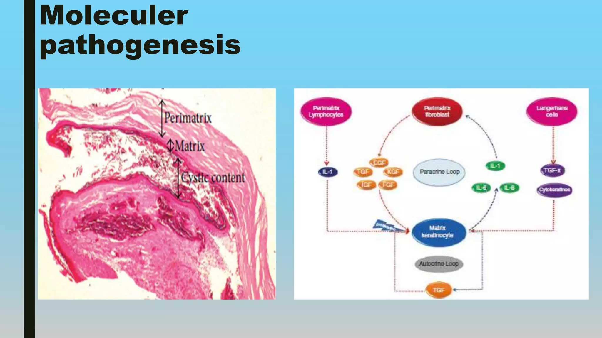 Cholesteatoma | PPTX