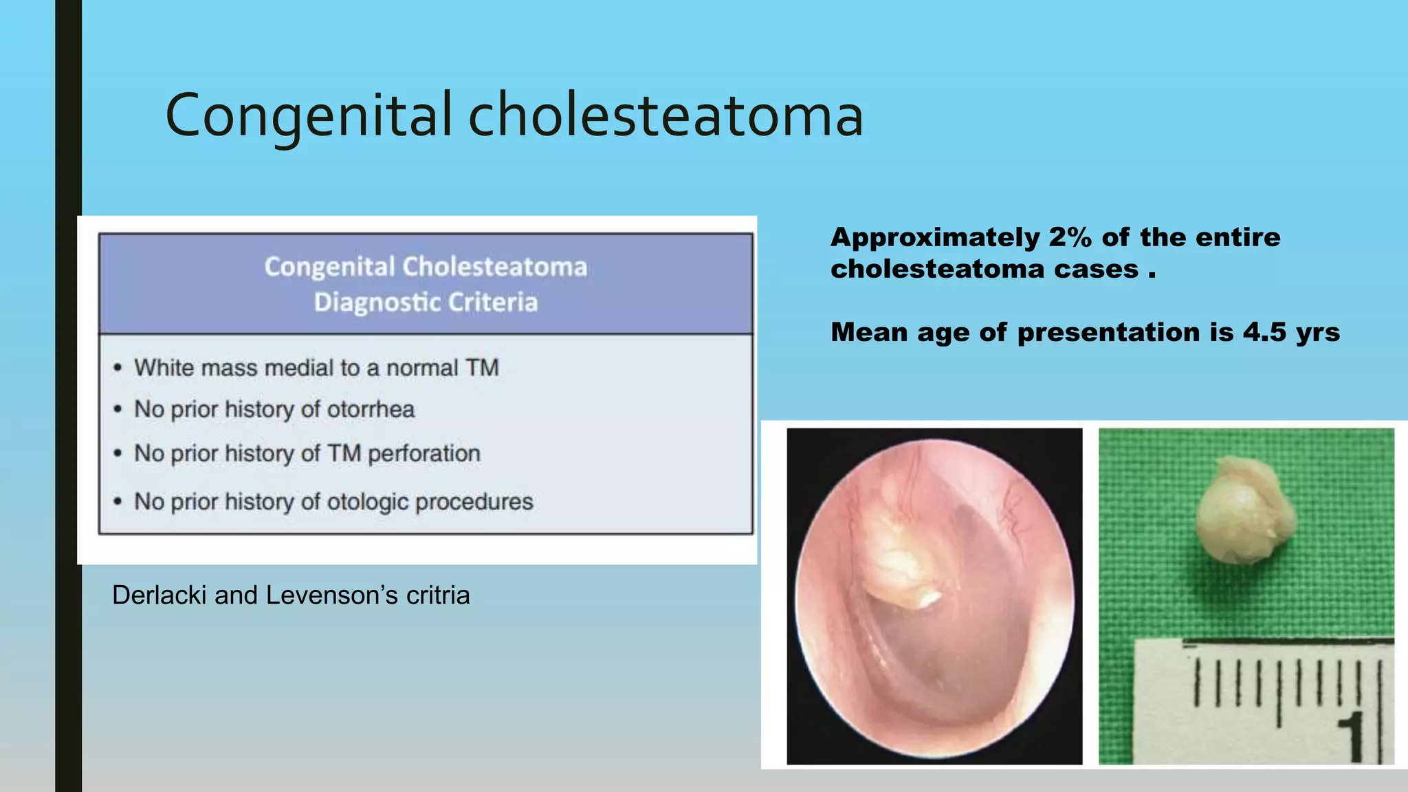 Cholesteatoma | PPTX