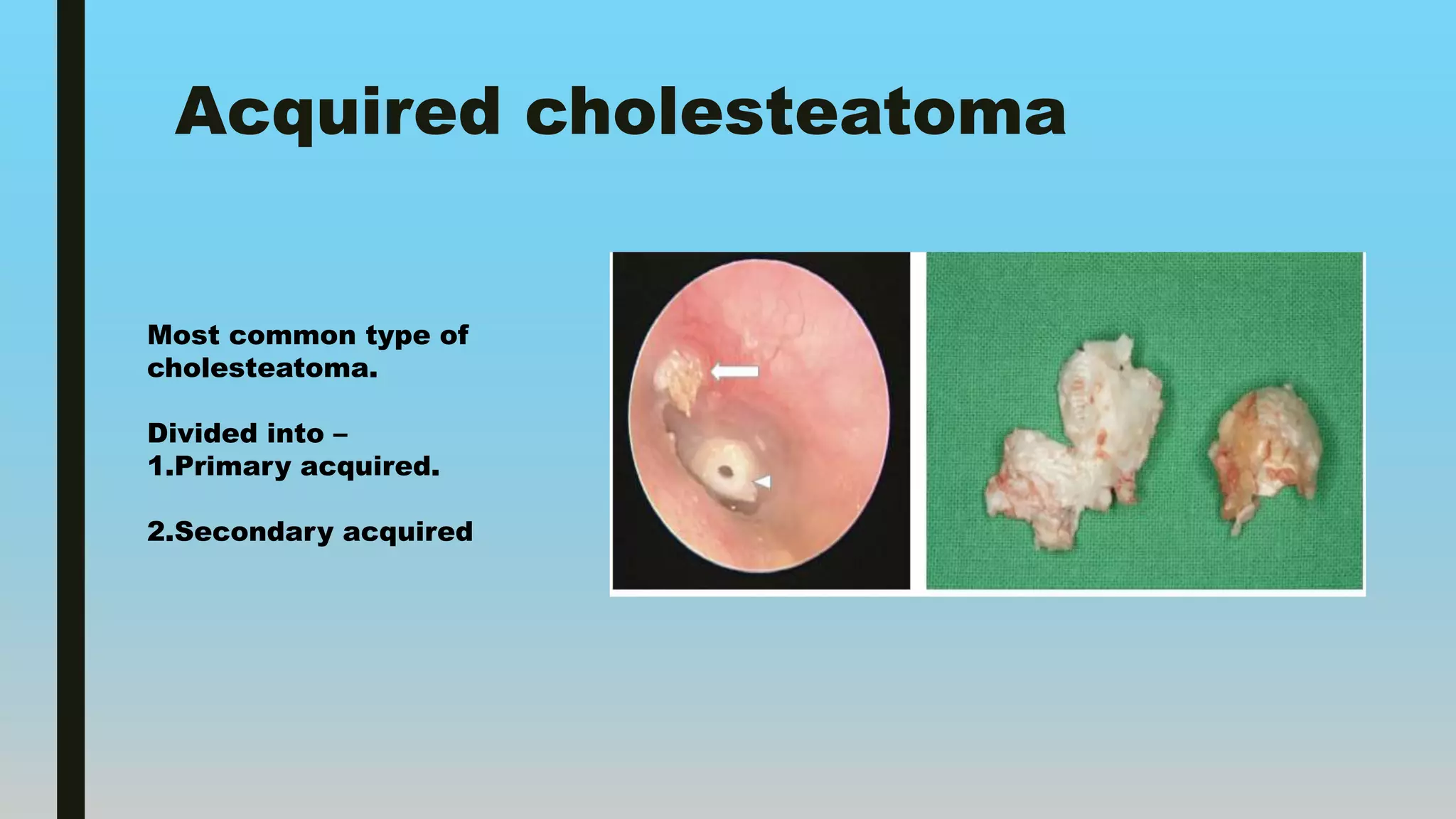 Cholesteatoma | PPTX