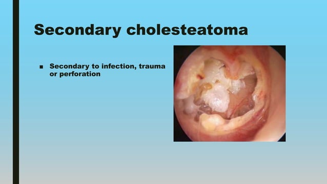Cholesteatoma | PPTX