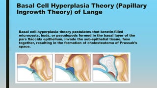 Cholesteatoma | PPTX